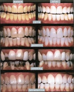 Common Questions About Teeth Staining